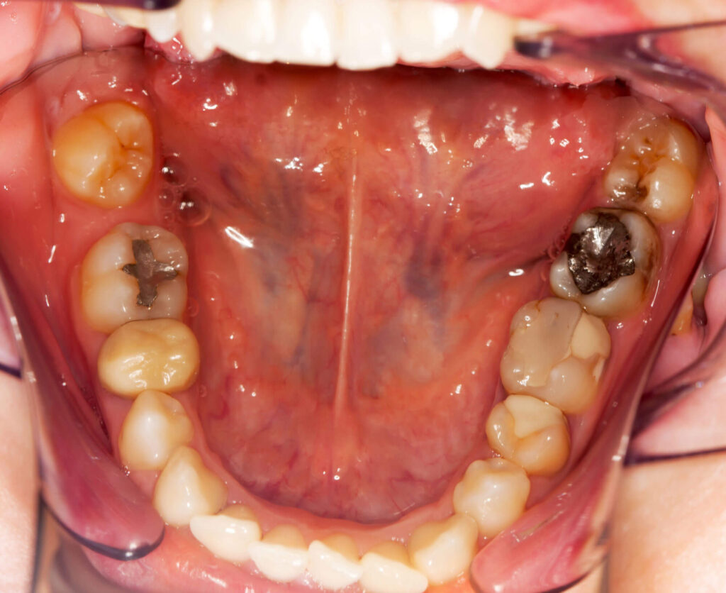 6 Most Common Types of Dental Fillings Explained